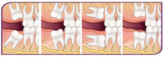 Măseaua de minte - o extragem sau nu? - Clinica Dr. Laura Rusu